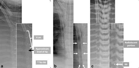 Venous Cannula Variants In Peripheral Veno Arterial Ecmo Download