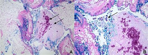 Histological Findings Of Mucocele In The Left Breast Lumpectomy A Download Scientific
