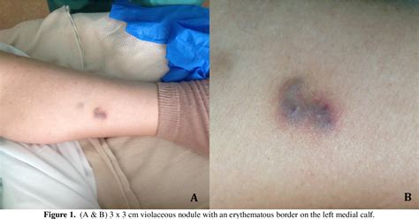 Figure 1 From A Violaceous Nodule In A Lung Transplant Patient Semantic Scholar