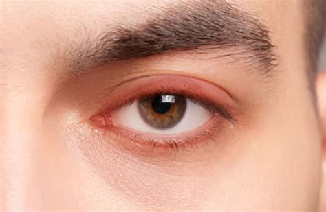 Blefarite Clinicavista