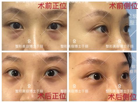 何谓不动刀激光去眼袋