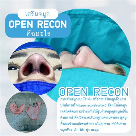 การเสริมจมูกแบบโอเพ่นคืออะไร Open Rhinoplasty หรือ Open Reconstruction คือการทำจมูกแบบเปิด