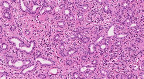 Your Pathology Report For Bile Duct Adenoma Mypathologyreport
