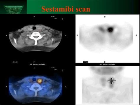 Hyperparathyroidism Types And Management Pptx