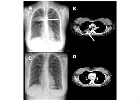 A Chest X Ray Showing A Opacity In The Right Lung Upper Zone B Ct