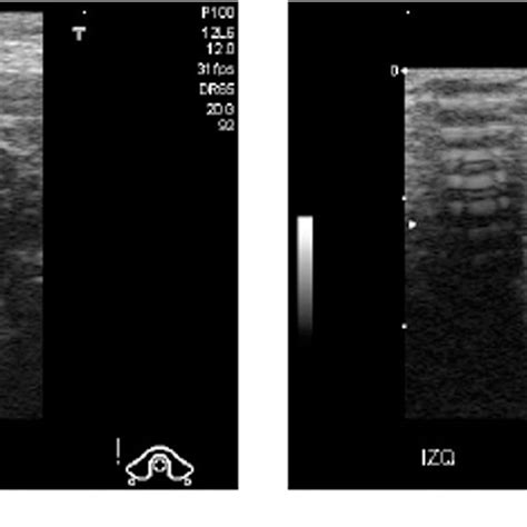 Example Of Thyroid Nodules A Benign Nodules B Malignant Nodules Download Scientific Diagram