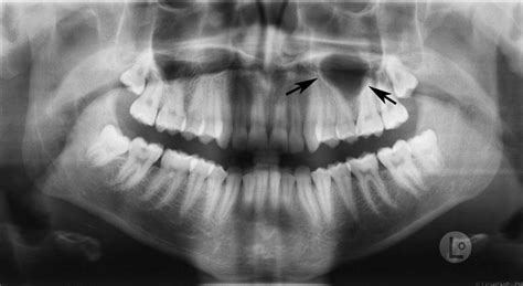 26 Paranasal Sinus Diseases Pocket Dentistry