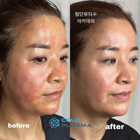 콜드플라즈마 1회하시고 2주후 2회 관리 전사진입니다 피부과도 Plasma Soo Gwangju