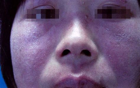 大疱性系统性红斑狼疮 皮肤病性病图谱