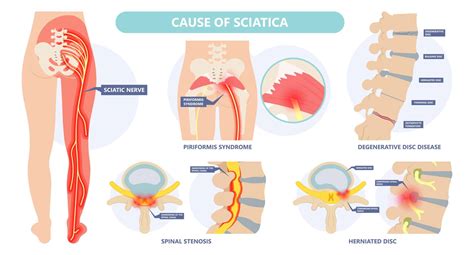 Sciatic Nerve Distribution