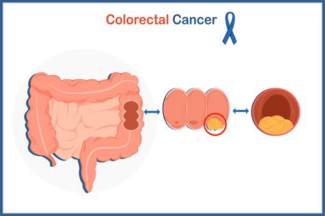 Colon Cancer Diagram
