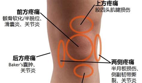 圣草康骨贴 滑膜炎还在用止痛药11种后果了解一下 疾病
