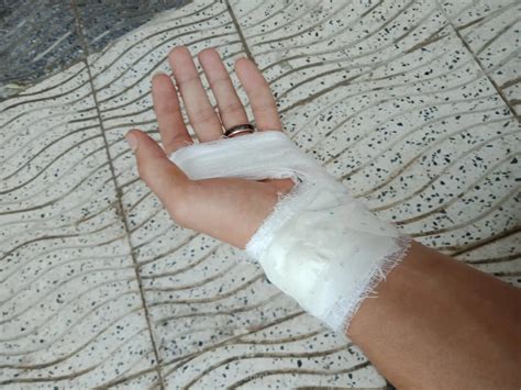 Pictures Of A Wounded Hand Wrapped In Real Gauze 2024 Basement