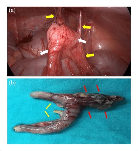 A The Laparoscopic Appearance Of The Appendix White Arrows Is