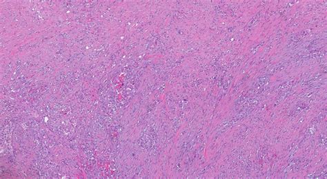 Adenosquamous Carcinoma Of The Pancreas Ottawa Atlas Of Pathology