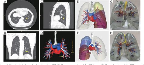 Table 1 From Artificial Intelligence Assisted Display In Thoracic Surgery Development And