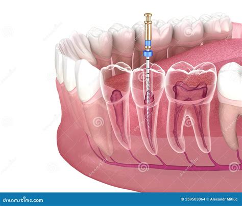 Endodontic Root Canal Treatment Process Medically Accurate Tooth 3d