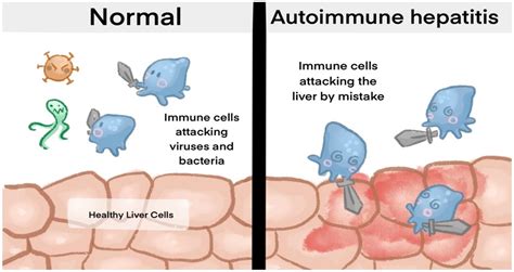 Clinical Liver Disease