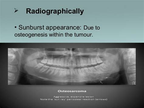 Osteosarcoma Sunburst Appearance
