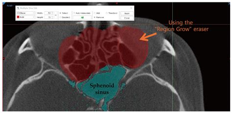 Three Dimensional Measurements Of Sphenoid Sinus Size By Sex In A