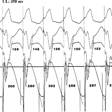 Monophasic Action Potential Map Recorded From The Right Ventricle Download Scientific Diagram