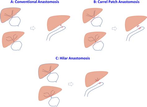 Conventional Hepaticojejunostomy Anastomosis A Versus Carrel Patch