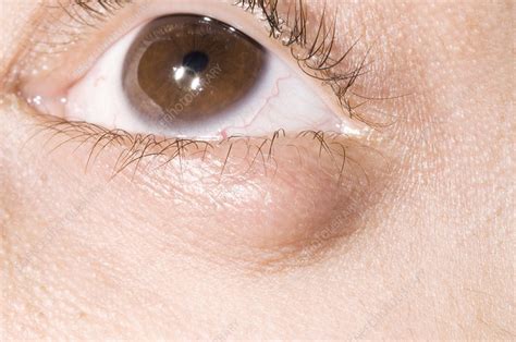 Chalazion Eyelid Cyst Causes Symptoms Treatment Healt
