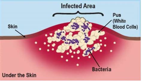 Skin Symptoms And Treatment Abscess Drainage Top Stories