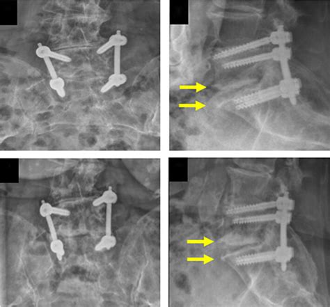 Magnetic Resonance Imaging Of The Lumbar Spine In Sagittal A And