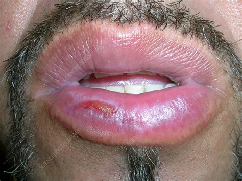 Actinic Cheilitis Stock Image C056 7897 Science Photo Library