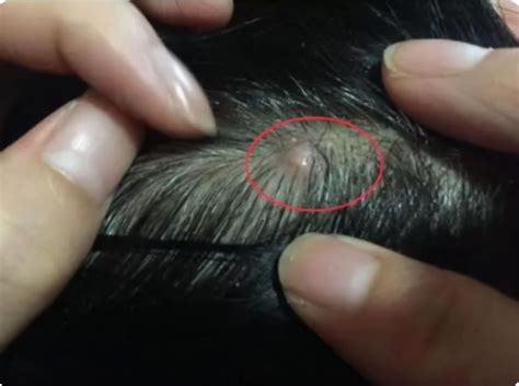 为什么头皮总长“脓包”和“疙瘩”？或许和4个原因有关 Peekme