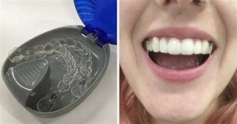 What Questions Do You Have About Invisalign