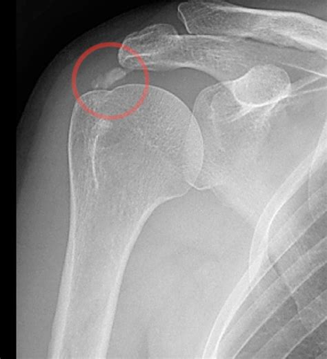 What Is Calcific Tendonitis Jorge A Gonzalez Md