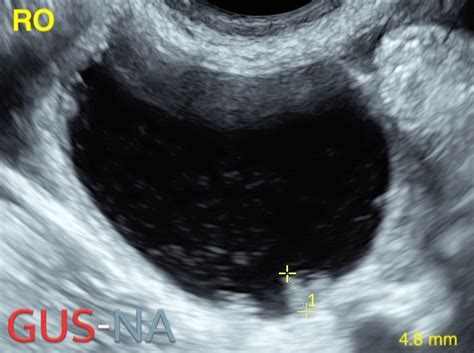 What Is A Solid Papillary Projection On Ultrasound Continuing Our Iotacongress And Orads