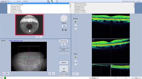 Optical Coherence Tomography Retina Center Of San Diego