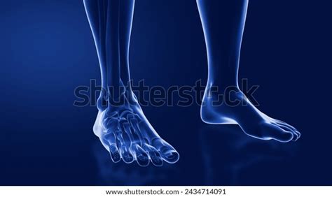 Ankle Dislocation Over 161 Royalty Free Licensable Stock Illustrations
