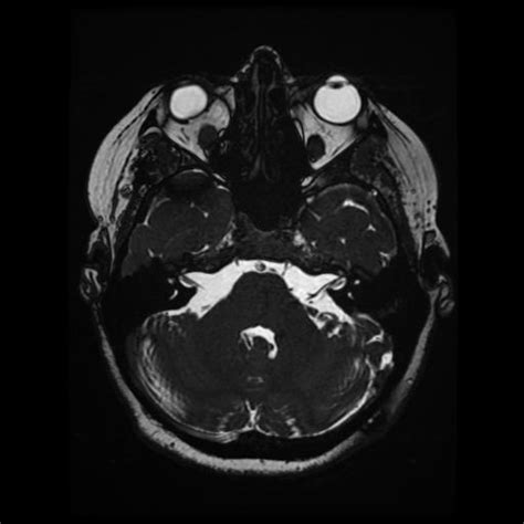 Neurovascular Compression Syndrome Trigeminal Nerve Radiopaedia 89835 106947 Axial Fiesta