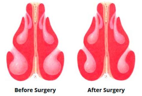 Finding Relief Who Can Benefit From An Inferior Turbinate Reduction