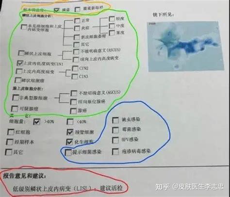 宫颈癌筛查：hpv和tct检查报告，各项指标详细解读！ 知乎