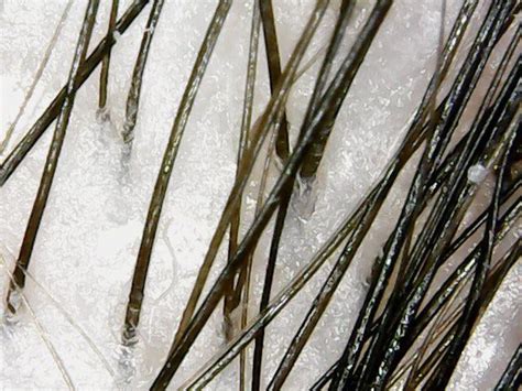 Does This Look Like Scarring Alopecia R Scarringalopecia