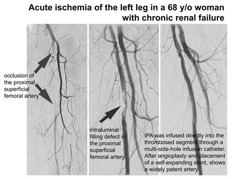 Acute Limb Ischemia Pdf