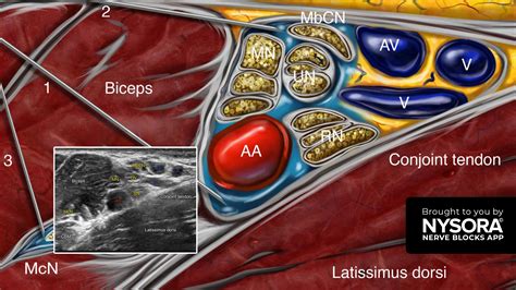 Brachial Plexus Block