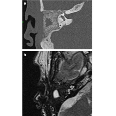 A Axial Ct Of The Right Mastoid Showing A Homogenous Distribution Of