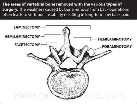 Foraminotomy Vs Laminectomy