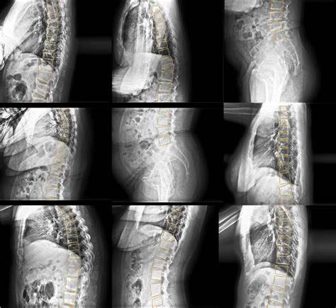 Github Limsungjoovertebrasegmentation Vertebra Lateral View X Ray Image