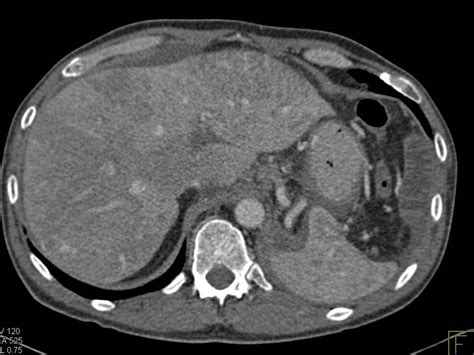 Carcinomatosis Due To Gi Primary Gastrointestinal Radiology Case