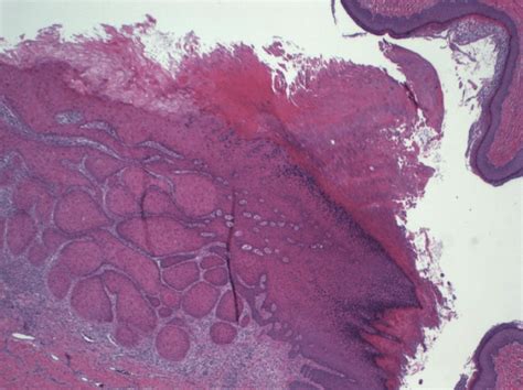 Low Power View Showing Atypical Squamoid Nests Arising From Wall Of Download Scientific Diagram