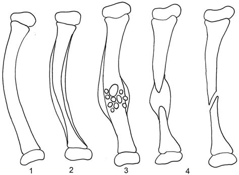 Pseudoartrose Congênita De Tíbia Dr David Nordon
