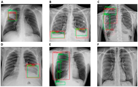 Clinical Evidence Chest Detection Ai Enhances Efficiency