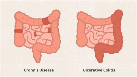 Ulcerative Colitis Treatment In Mumbai Dr Chintamani Godbole